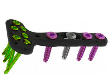 WRIST FRACTURES AND INNOVATIVE PLATES - Leghe Leggere