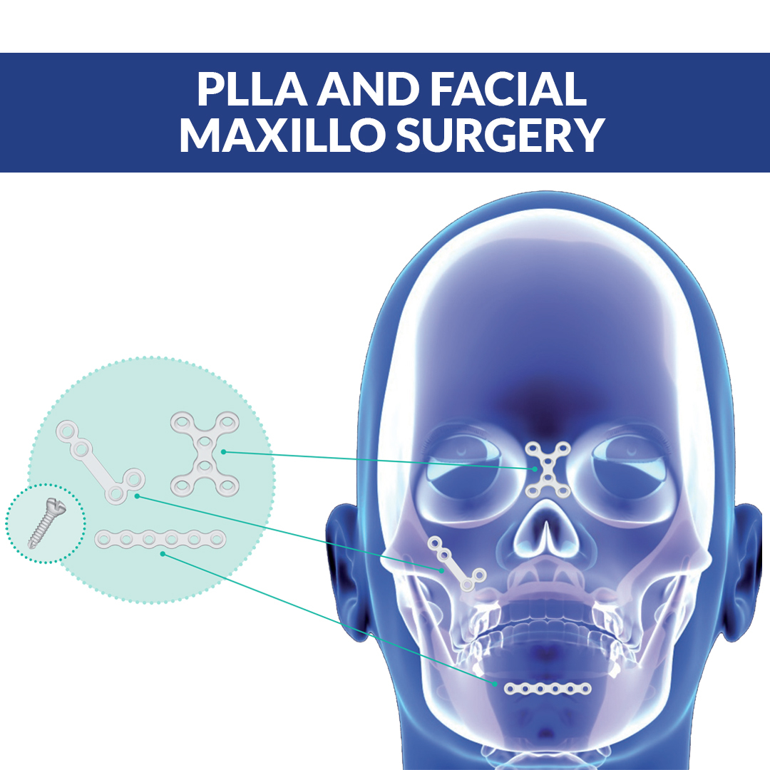 Il PLLA nella chirurgia maxillofacciale - Leghe Leggere